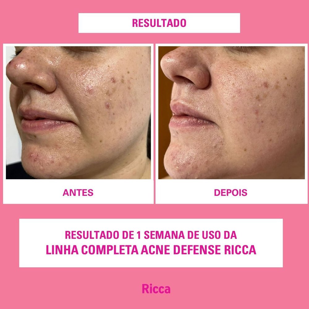 Tônico Facial Ricca Acne Defense 140ml